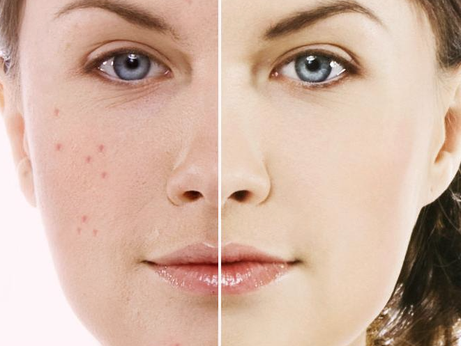 El mejor tratamiento contra el acné | Consejo Mujer